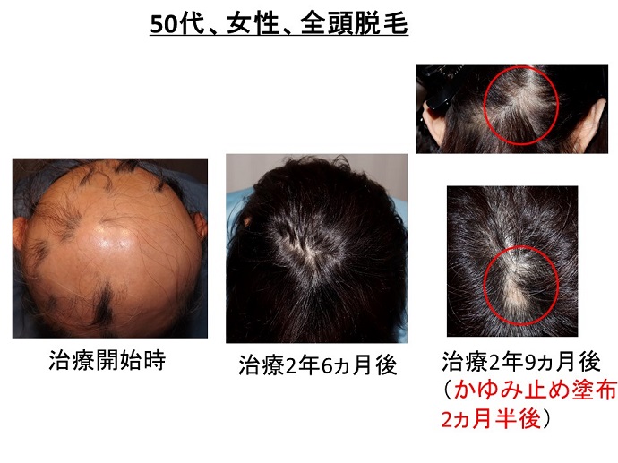 円形脱毛症の完治直前に、かゆみ止めを塗って再発！ 患者様からの声・メディア掲載・クリニックからのお知らせ 名古屋kクリニック